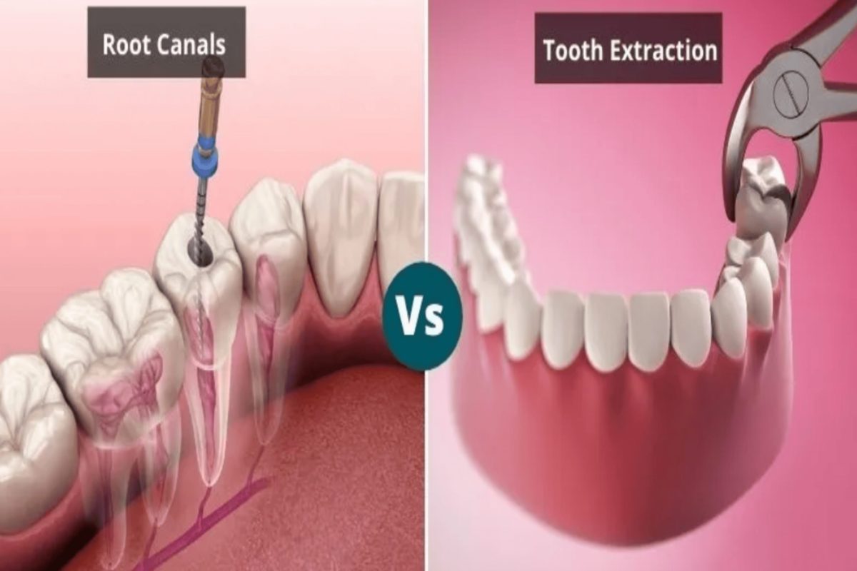 Root Canal vs Extraction: Which Is the Better Option?