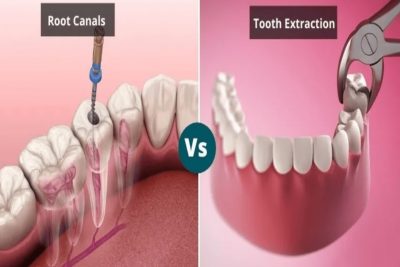 Root Canal vs Extraction: Which Is the Better Option?