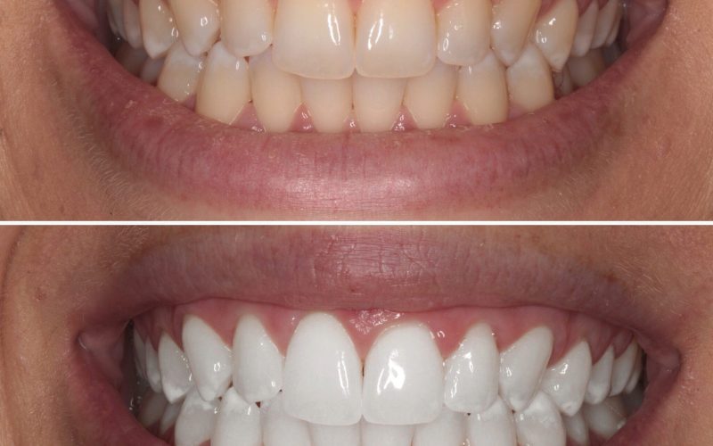 Dangers of DIY Teeth Whitening: Avoid These Risks